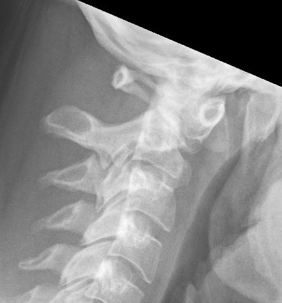 Atlanto-axial instability | The Bone School